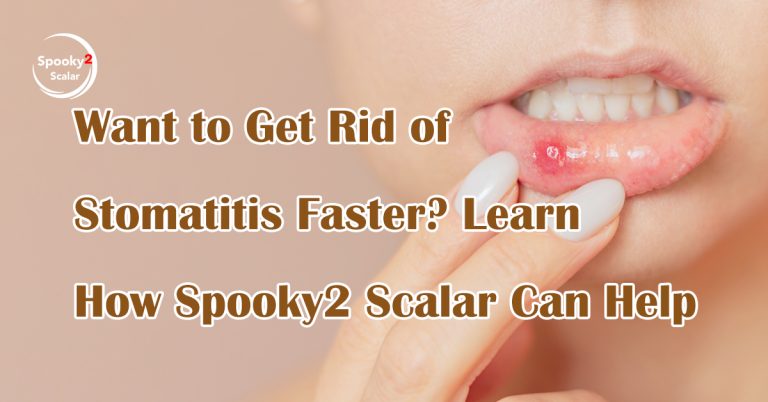 Heal Stomatitis Faster with Spooky2 Scalar: A olution